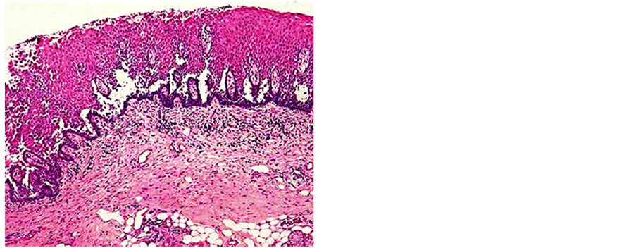 Two Cases of Hallopeau Type of Pemphigus Vegetans in Two Women in ...