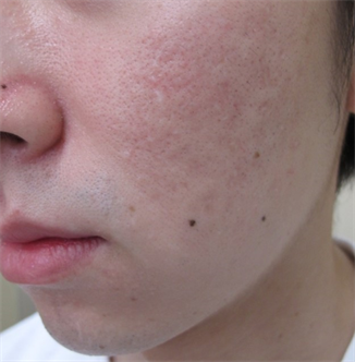 Comprehensive Sequential Successful Therapy Comprising Chemical Peeling ...