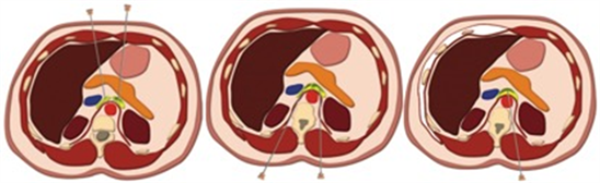 Review of Coeliac Plexus Blockade for the Management of Chronic ...