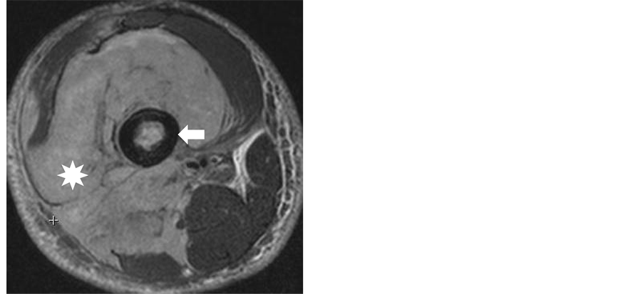 Primary Lymphoma of Bone: Imaging Findings to Improve Diagnosis of a ...