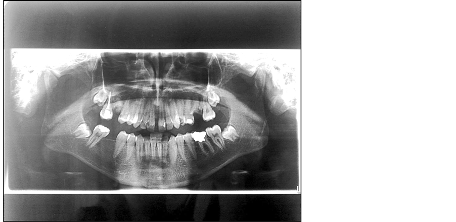 Maxillary Second Molar with Single Root and Single Canal—Case Report