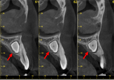 Benefits of Using CBCT in Bilateral Maxillary Impacted Canines ...