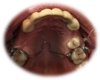 Orthodontic Intrusion of over Erupted Permanent Maxillary Molars Using ...
