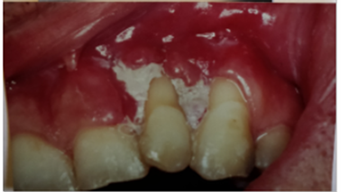 Origins and Recovery from Superinfections and Soft Tissue Necrosis