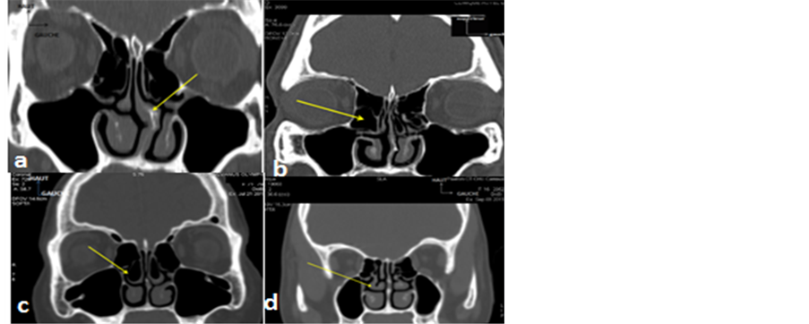 Mechanical Confining of Sinonasal Anatomic Variants by Computer ...