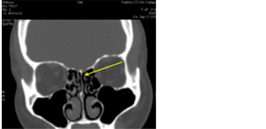 Mechanical Confining of Sinonasal Anatomic Variants by Computer ...