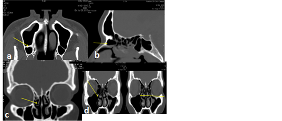 Mechanical Confining of Sinonasal Anatomic Variants by Computer ...