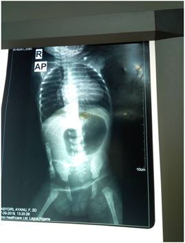 Role of Plain Abdominal X-Ray in the Differential Diagnosis of Common ...