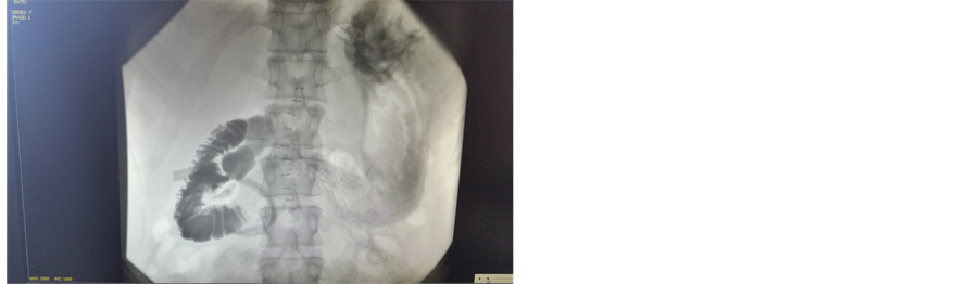 Ileus Caused by Large Diverticulum of Postbulbar Duodenum: Case Report