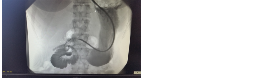 Ileus Caused by Large Diverticulum of Postbulbar Duodenum: Case Report