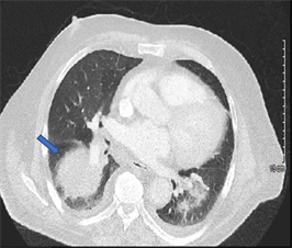 Oval-Shaped Radiographic Opacity Mimicking a Lung Mass