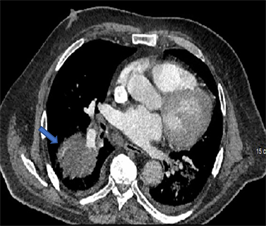 Oval-Shaped Radiographic Opacity Mimicking a Lung Mass
