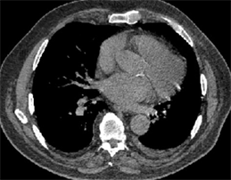 Oval-Shaped Radiographic Opacity Mimicking a Lung Mass