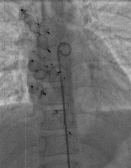 Isolated Major Aortopulmonary Collateral Artery Causing Heart Failure ...