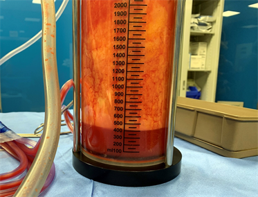 Using Tallquist Haemoglobin Scale for Estimating Intraoperative Blood ...