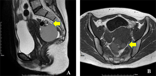 A Case of Struma Ovarii Diagnosed by Cytology during Laparoscopic Surgery