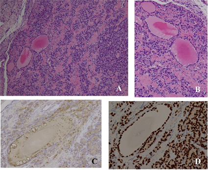 A Case of Struma Ovarii Diagnosed by Cytology during Laparoscopic Surgery