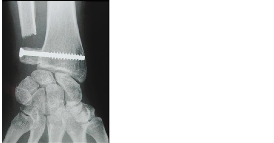 Results of the Sauvé-Kapandji Procedure for Posttraumatic Disorders of ...