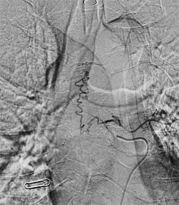 A Patient with Spinal Arteriovenous Malformation Treated with Lumbar ...