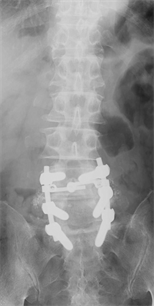 A Patient with Spinal Arteriovenous Malformation Treated with Lumbar ...