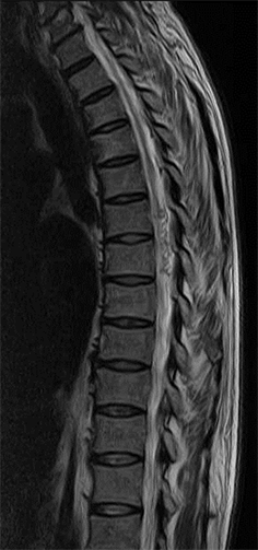 A Patient with Spinal Arteriovenous Malformation Treated with Lumbar ...