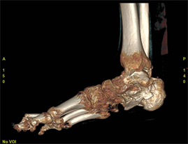 First Ever Documented Total Calcaneus Replacement with 3D Printed ...