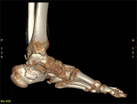 First Ever Documented Total Calcaneus Replacement with 3D Printed ...