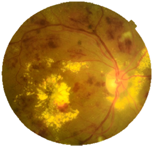 Hypertensive Retinopathy in Guinean Hypertensive Women: Epidemiological ...