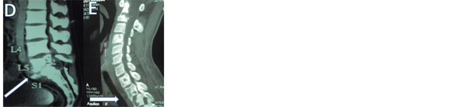 Multilevel Cervicothoracic and Lumbar Pott’s Disease: About Three New ...