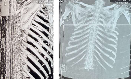 Rib Osteosynthesis for Sub-Acute Management of a Flail Chest in a ...