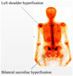 Contribution of Bone Scintigraphy in the Diagnosis of a Case of SAPHO ...