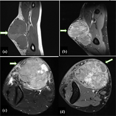 Atlas of Elbow Soft Tissue Pathologies Using Magnetic Resonance Imaging ...