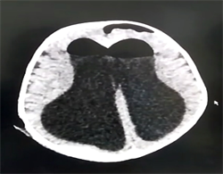 Endoscopic Third Ventriculostomy versus Ventriculo-Peritoneal Shunt for ...