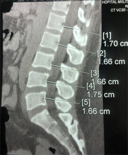 Hyperalgesic Lumbosciatica Symptomatic of a Spinal Schwannoma: A Case ...