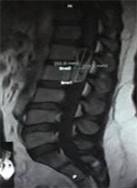 Hyperalgesic Lumbosciatica Symptomatic of a Spinal Schwannoma: A Case ...