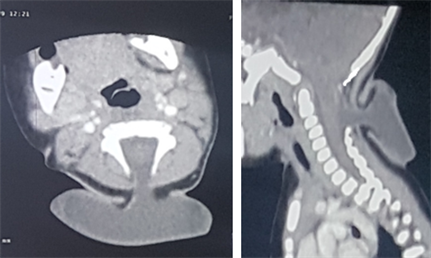 Cervical Meningocele about 2 Operated Cases