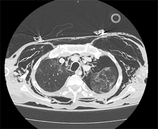 Pneumoscrotum in a Patient with Pneumocystis jirovecii Pneumonia: A ...