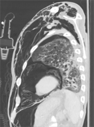 Pneumoscrotum in a Patient with Pneumocystis jirovecii Pneumonia: A ...