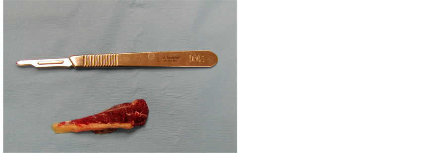 Ankle Arthroscopy, Lateral Ligament Repair and Peroneal Tendon Reefing ...