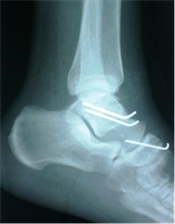 Management of Subtalar Fractures-Dislocations at Ségou Hospital in Mali ...