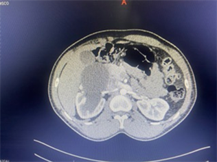 Laparoscopic Transperitoneal Pyeloplasty for Ureteropelvic Junction ...