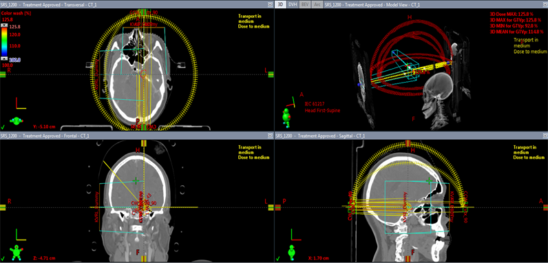 The Journey of SRS: An Initial Experience of Starting Sterotactic ...