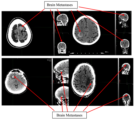 Image Application in Single Isocenter Multiple Target SRS