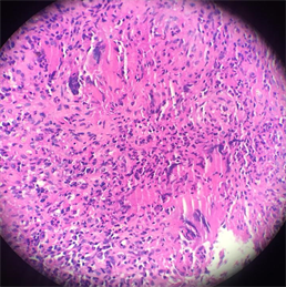 Extra-Pulmonary Tuberculosis in the Uterine Cervix: A Case Report