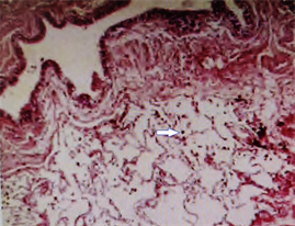 Effect of Micropapillary Pattern and Spread through Air Space in ...