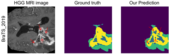 Brain Tumor Segmentation of HGG and LGG MRI Images Using WFL-Based 3D U-Net