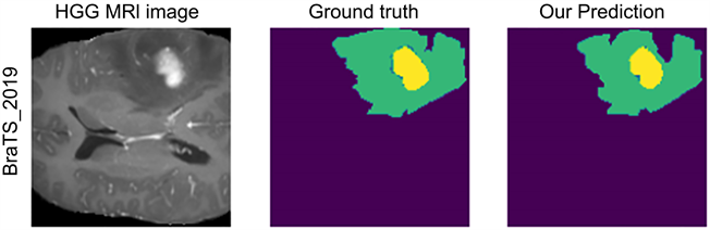 Brain Tumor Segmentation of HGG and LGG MRI Images Using WFL-Based 3D U-Net