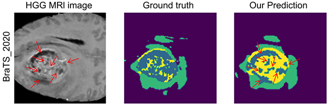 Brain Tumor Segmentation of HGG and LGG MRI Images Using WFL-Based 3D U-Net