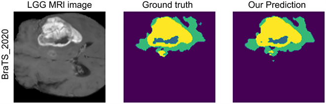 Brain Tumor Segmentation of HGG and LGG MRI Images Using WFL-Based 3D U-Net