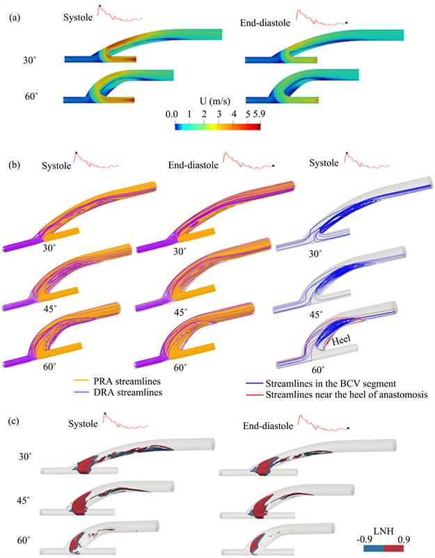 A Computational Analysis of the Influence of Anastomosis Angle on ...